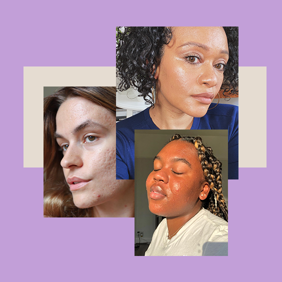 How this beauty journalist embraced her own #SkinPositivity – wearefaace